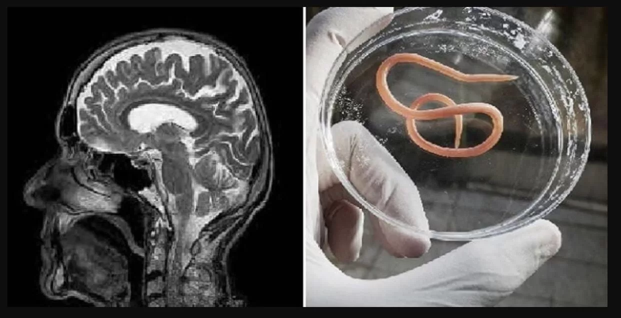 Live Worm Found in Woman's Brain - Global Village Space